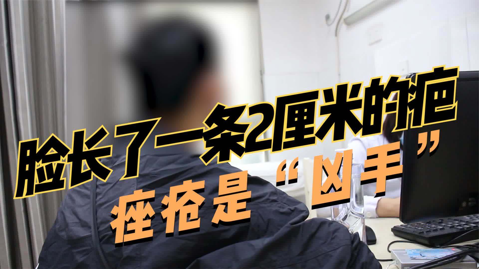 男子脸上一条2厘米的疤,痤疮引发的,医生:34岁长这么多疤痕?