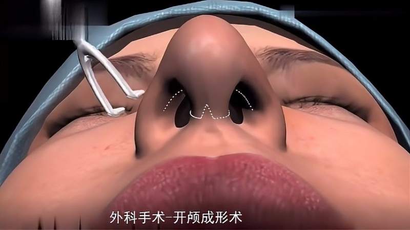 动画演示隆鼻手术过程,效果好,看着疼!