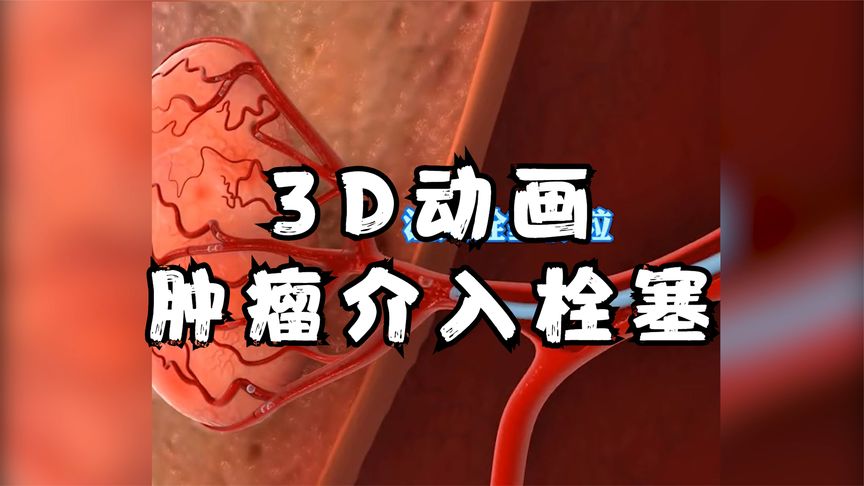 3D动画-肿瘤介入栓塞