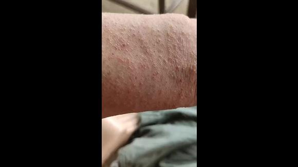 夏天最常见的一种皮肤病—痱子