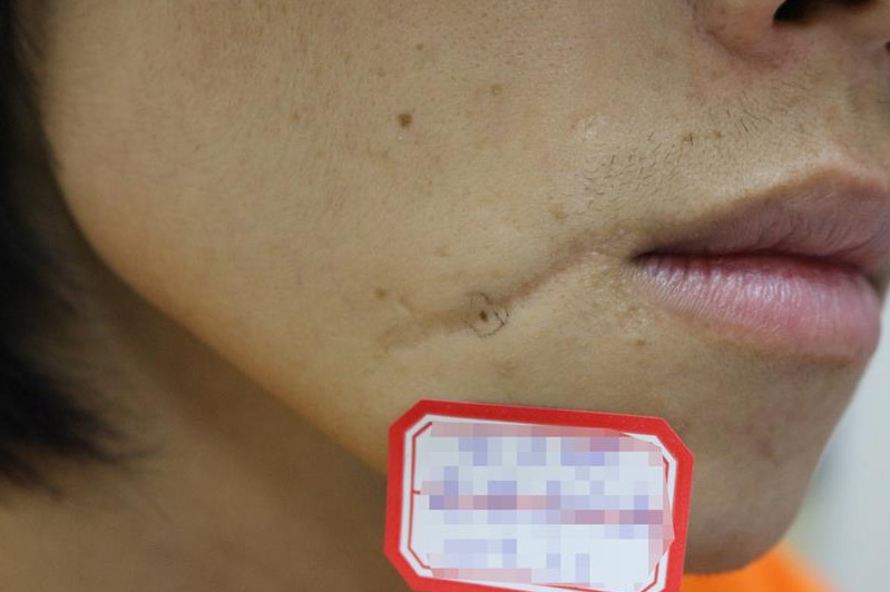 河北省中医院:疤痕凹陷了怎么办