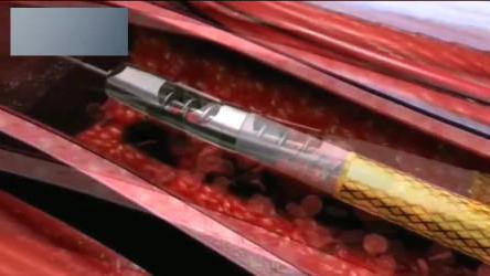 治疗动脉粥状硬化这手术操作,对医生来说应该是个考验吧!