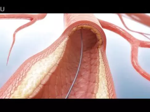 血管扩张动画15384449887