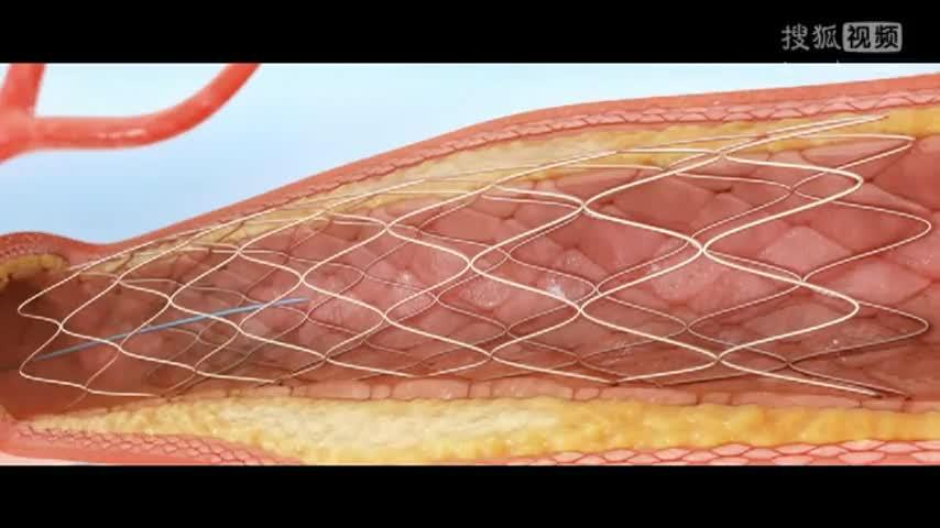 SP-23-血管扩张动画
