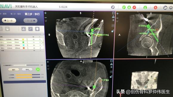 只有人类才会做手术?—人工智能在骨科领域大显神通