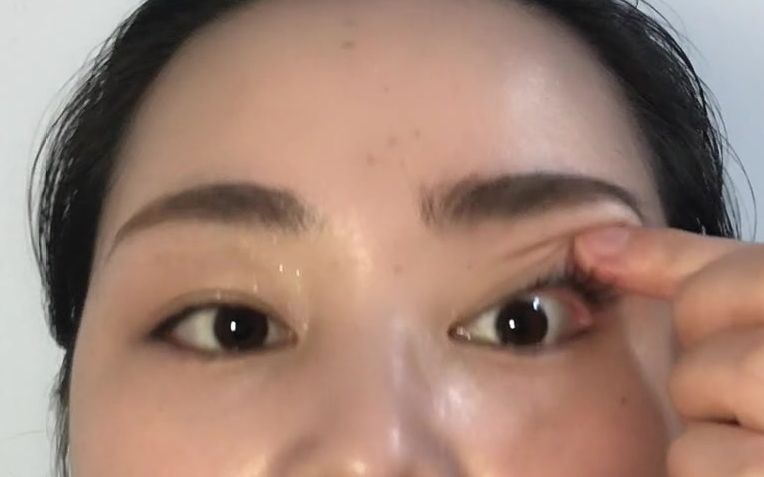 眼睑长了小水泡是一种什么样的体验