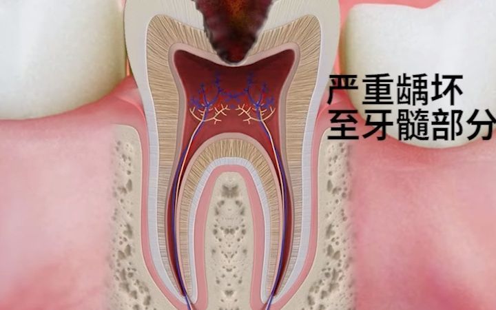 3D模拟根管治疗全过程!严重蛀牙注意了!