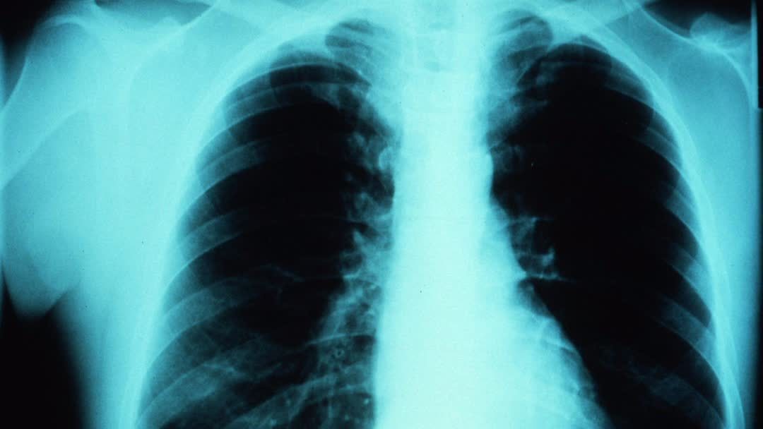 《健康讲座》哮喘病需要终身用药吗?