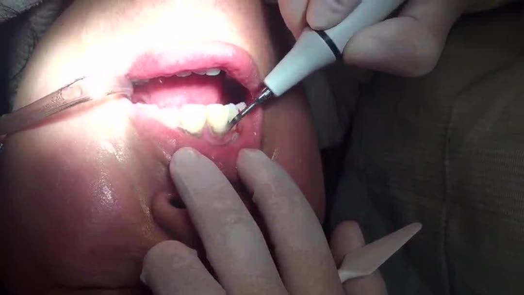 重口味,牙结石牙周病患者洗牙过程,大块牙结石全程高能