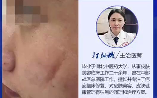 武汉太医堂解答外伤凹陷疤痕该怎么修复?