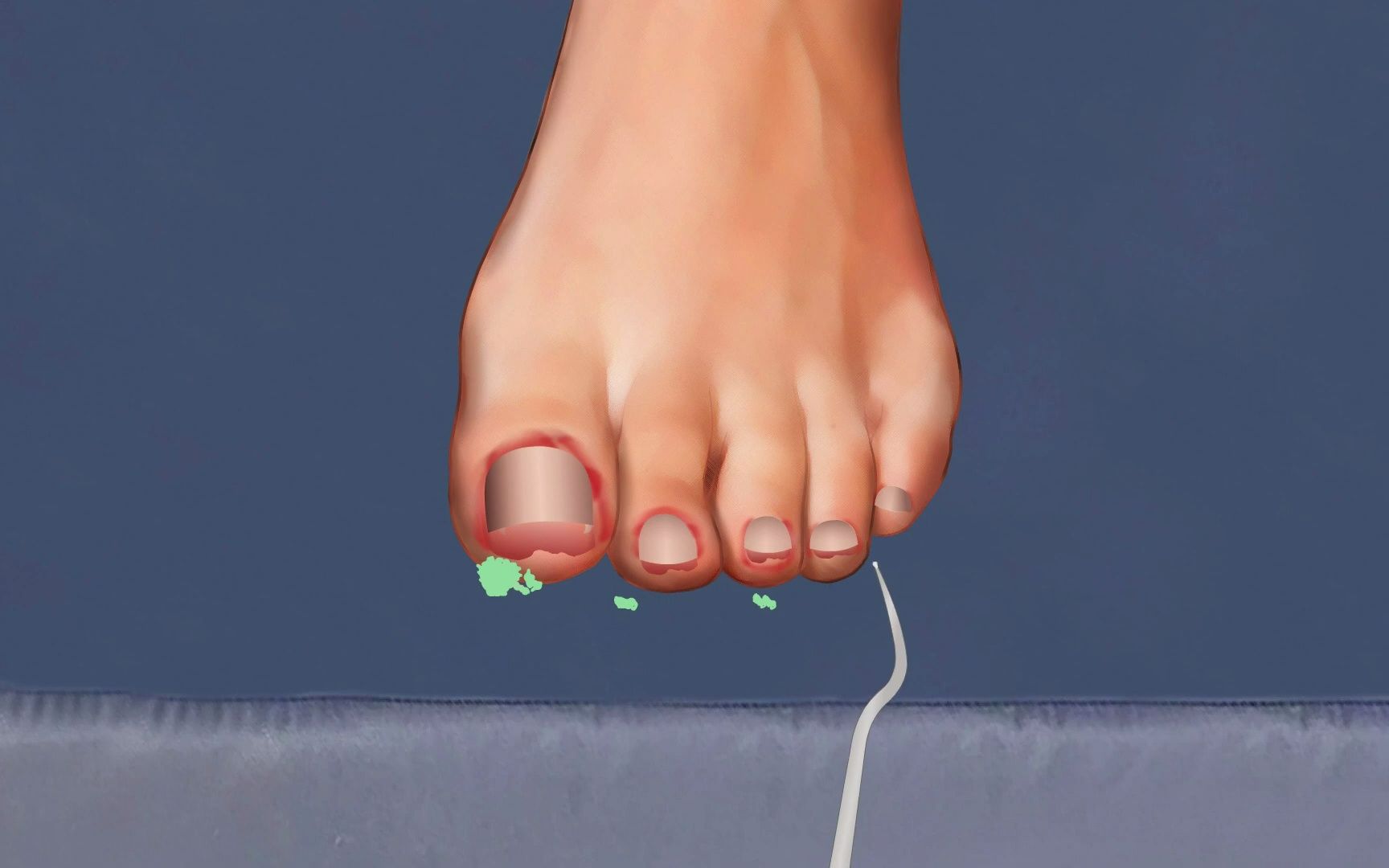 【沉浸式修脚】最令人满意的内生脚趾甲去除治疗动画