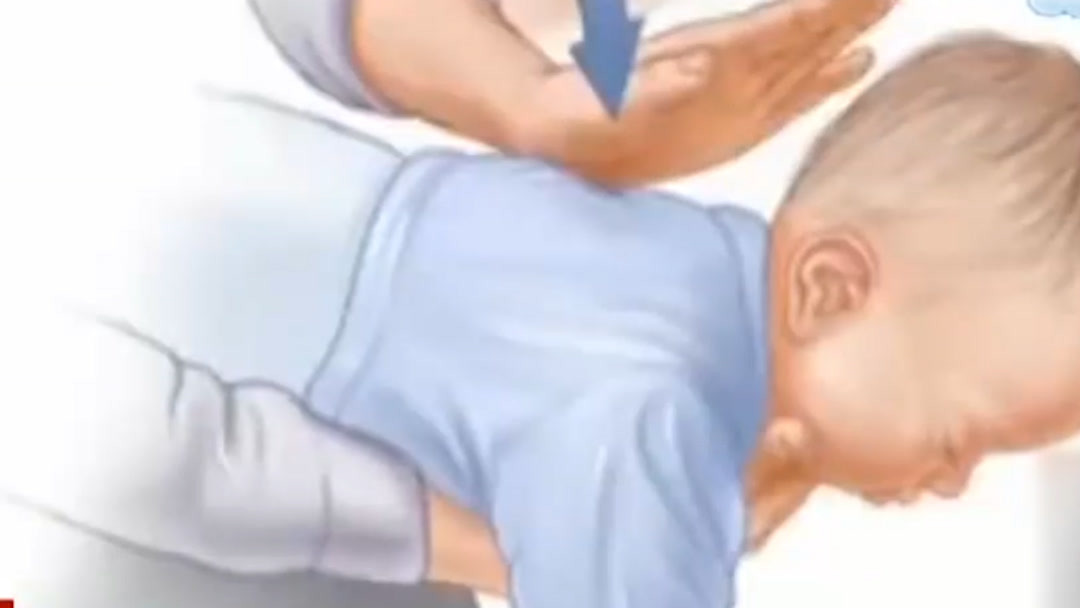 气道异物堵塞“海姆立克”急救法有大用,关键时候能救命,来学学