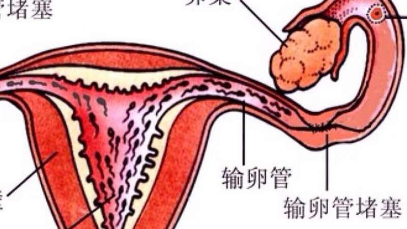输卵管堵塞好治吗?
