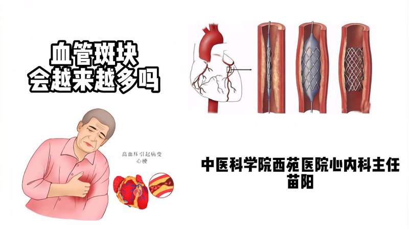 横屏动画 血管斑块会越来越多吗