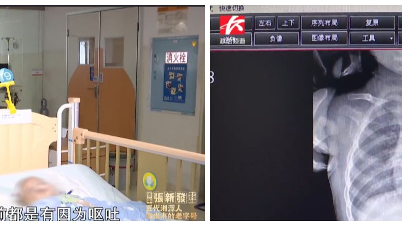 2幼童均因吞食纽扣电池被送进ICU,医生检查后一句话急坏家长