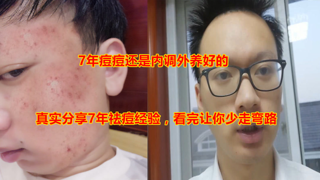 痘痘治不好的2大严重后果!简单一个方法,搞定痘痘再也不发愁