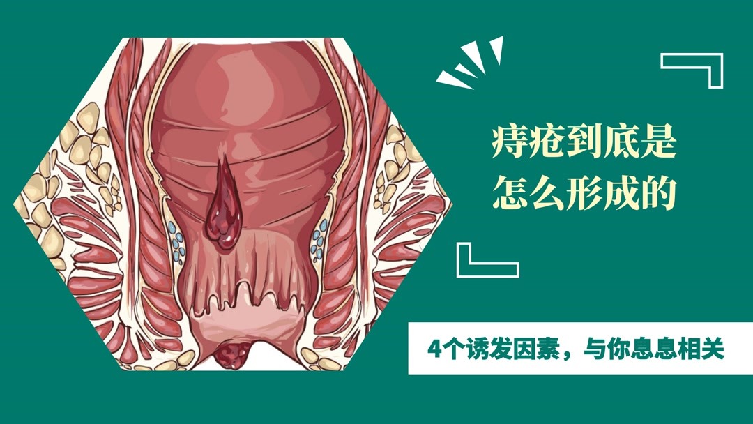 痔疮到底是怎么形成的?提醒:4个诱发因素,与你息息相关