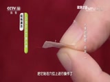 [健康之路]现场演示:小揿针治疗偏头痛