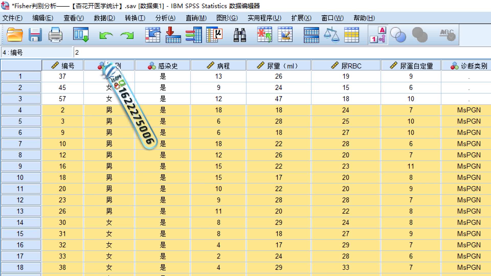 ...中进行Fisher判别分析的具体操作及研究意义【杏花开医学统计】