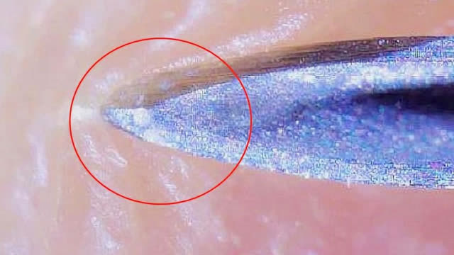 高倍显微镜下看人打针针管是不规则的,一层层的扎进去!