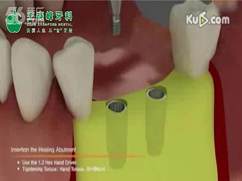 牙齿种植 动画操作