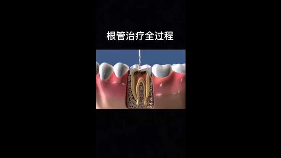 根管治疗全过程