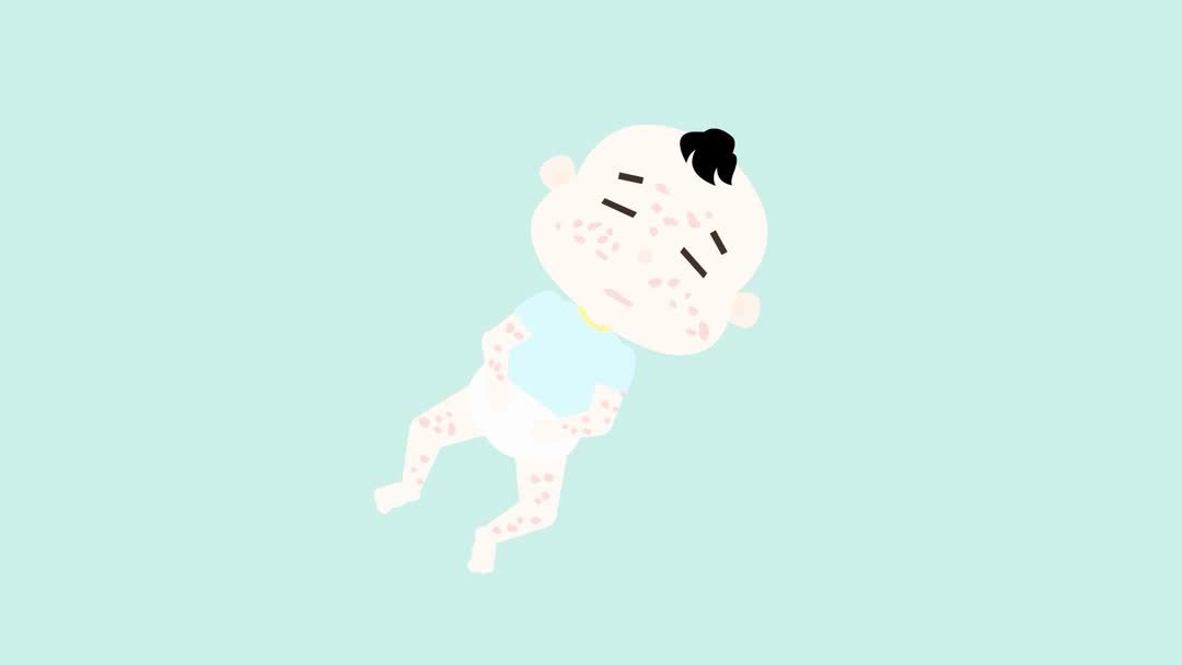 婴儿湿疹的最佳治疗方法是什么?用什么药膏好?