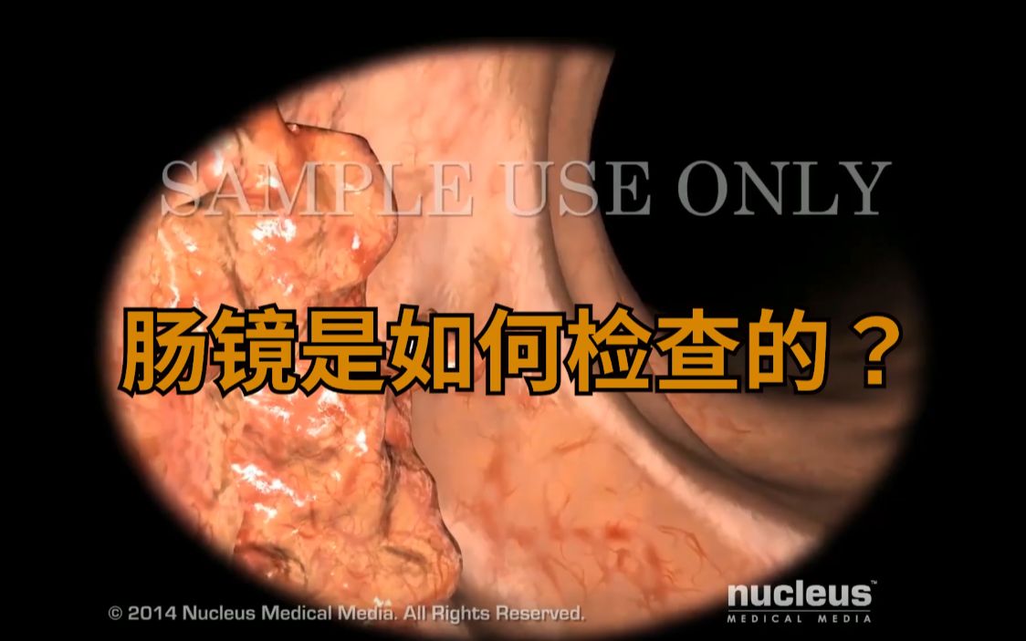 【医学科普】肠镜是如何检查的?