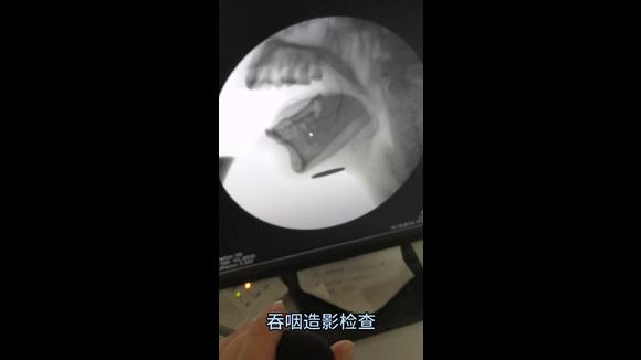 你知道吞咽食物的整个过程吗?吞咽障碍又是怎么回事呢?造影来了