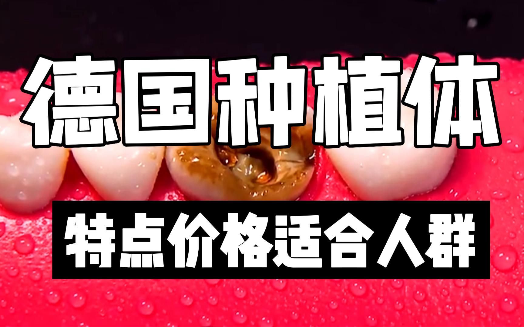 德国种植牙品牌介绍性价比适合人群