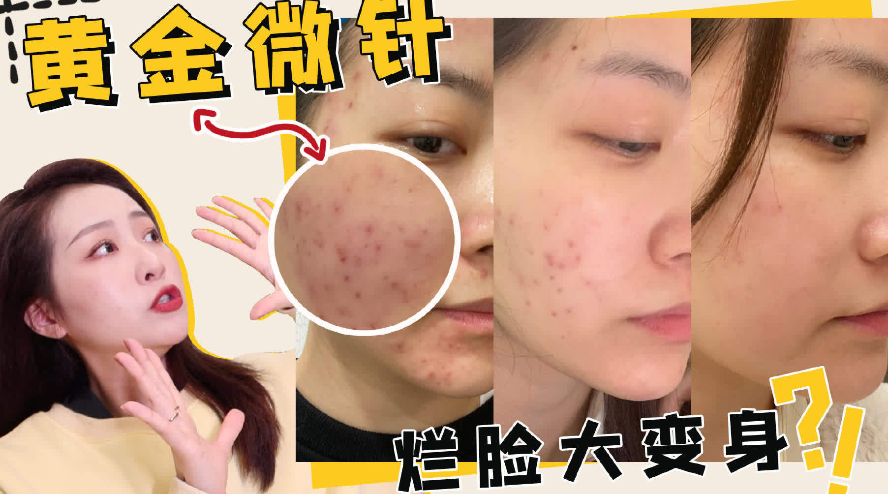 黄金微针?烂脸真的有用吗?