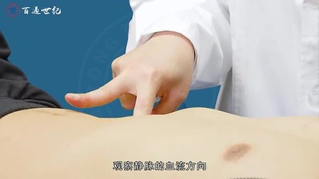 医师资格考试 实践技能 腹壁静脉