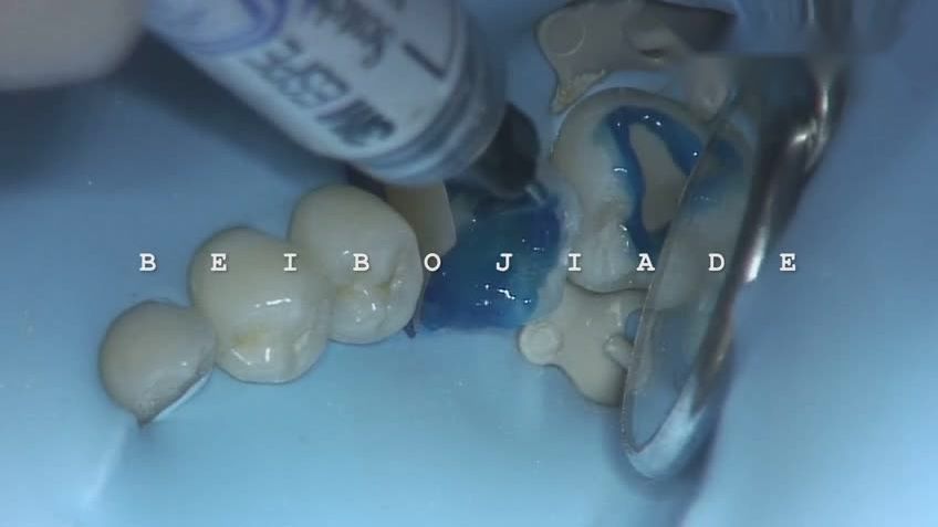 嵌体-橡皮障下粘接「口腔工具视频介绍」