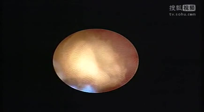 输尿管镜钬激光碎石术示范-同济大学附属天佑医院