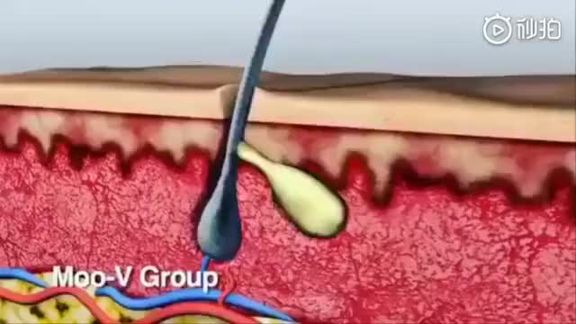 3D动画演示:痘痘、痘坑、痘印是怎样形成的