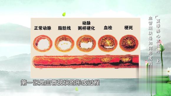 血管斑块不同程度的堵塞会对身体造成的危害