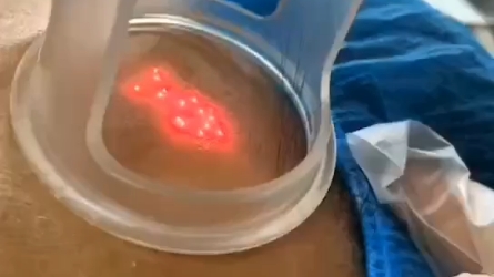 点阵激光瘢痕治疗中,四维立体抗衰,重塑真皮框架组织,针对毛孔粗大,...