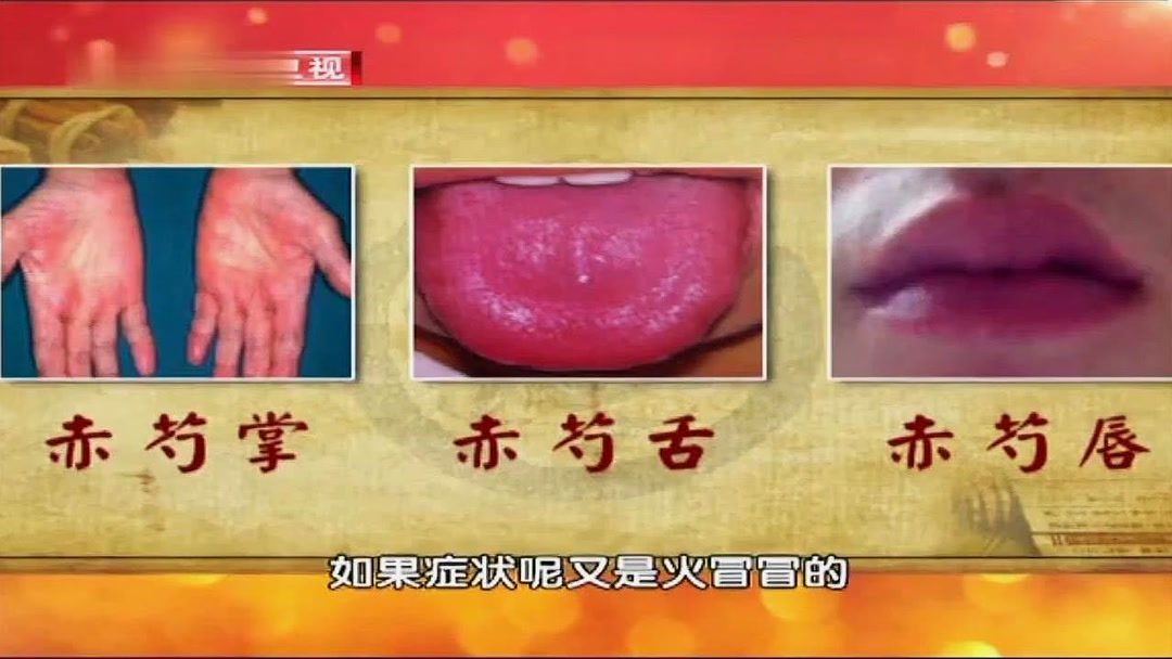 嘴唇和舌头暗紫不是上火那么简单!糖尿病的一大信号,别不重视它