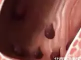 三维医学动画-痔疮治疗展示