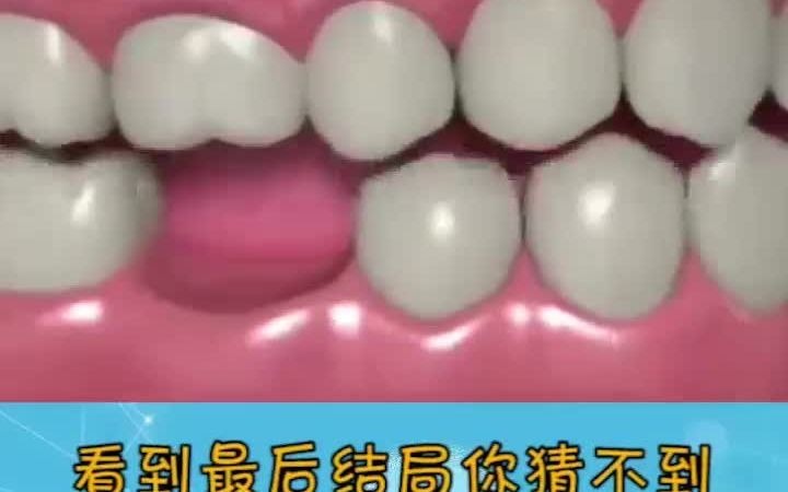 #合肥种牙多少钱一颗##佳德口腔##种植牙#缺牙不种的后果多吓人?