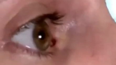 近视了不戴眼镜有啥后果没?