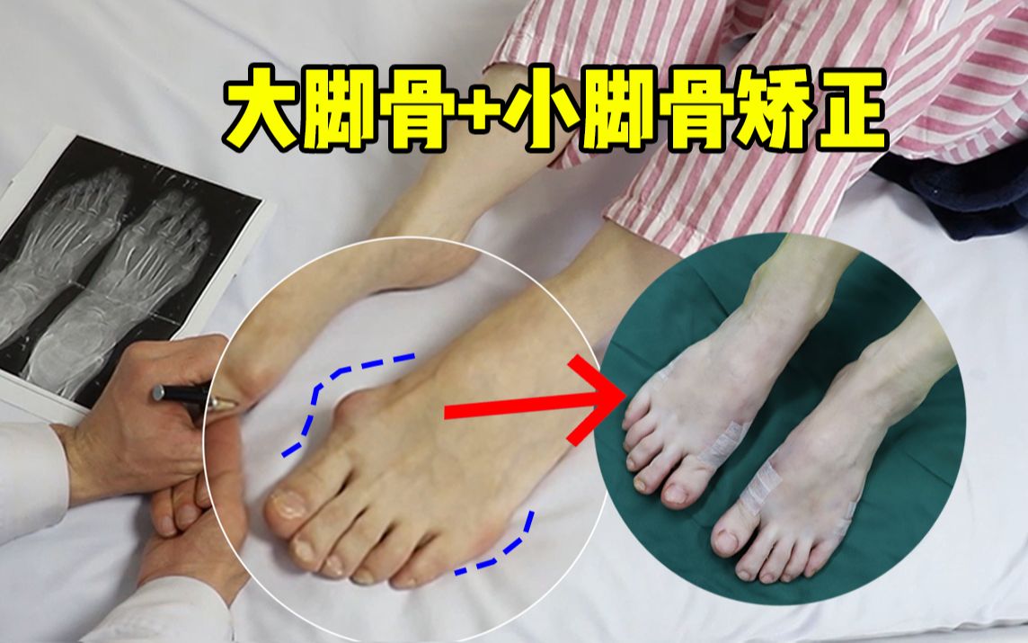 【苏敬达】50岁武汉女士来手术,长了4年多的拇外翻和小脚骨,终于没有...