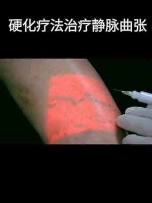 静脉曲张硬化疗法:通过注射器,将泡沫状的特殊硬化剂注入静脉来进行.
