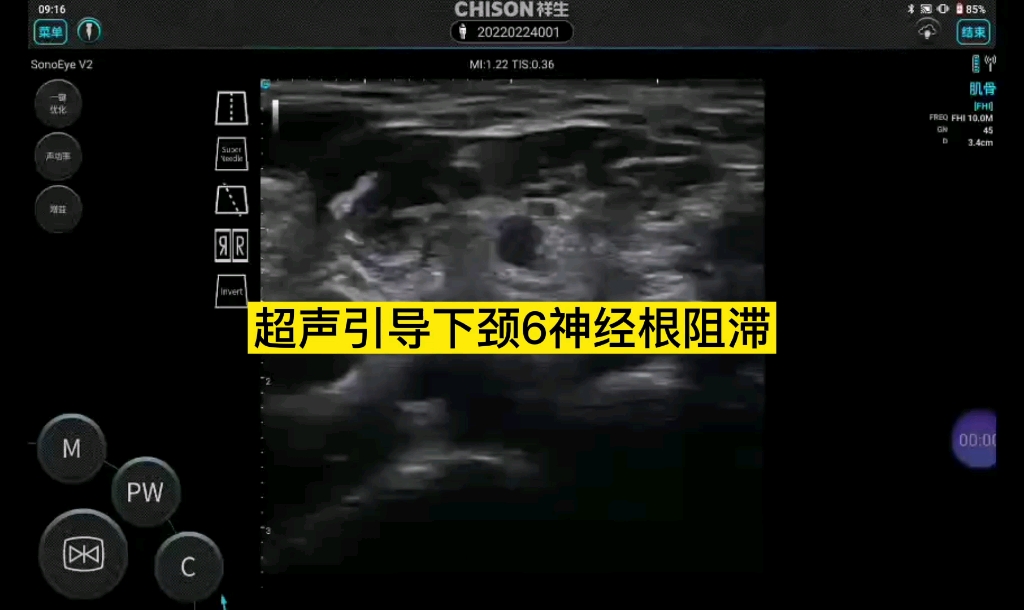 超声引导下神经根阻滞。患者以左上肢剧烈疼痛来诊,诊断为神经根型...