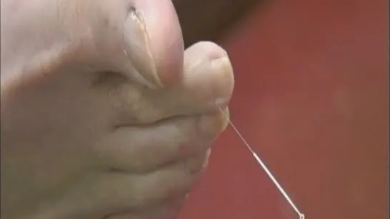 心脏毛病心绞痛的针灸治疗,巨阙穴和关元穴是关键