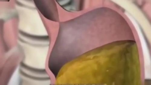 便秘没排出体外的大便,经常堆积在肠道有害健康,人们应该引起重视!