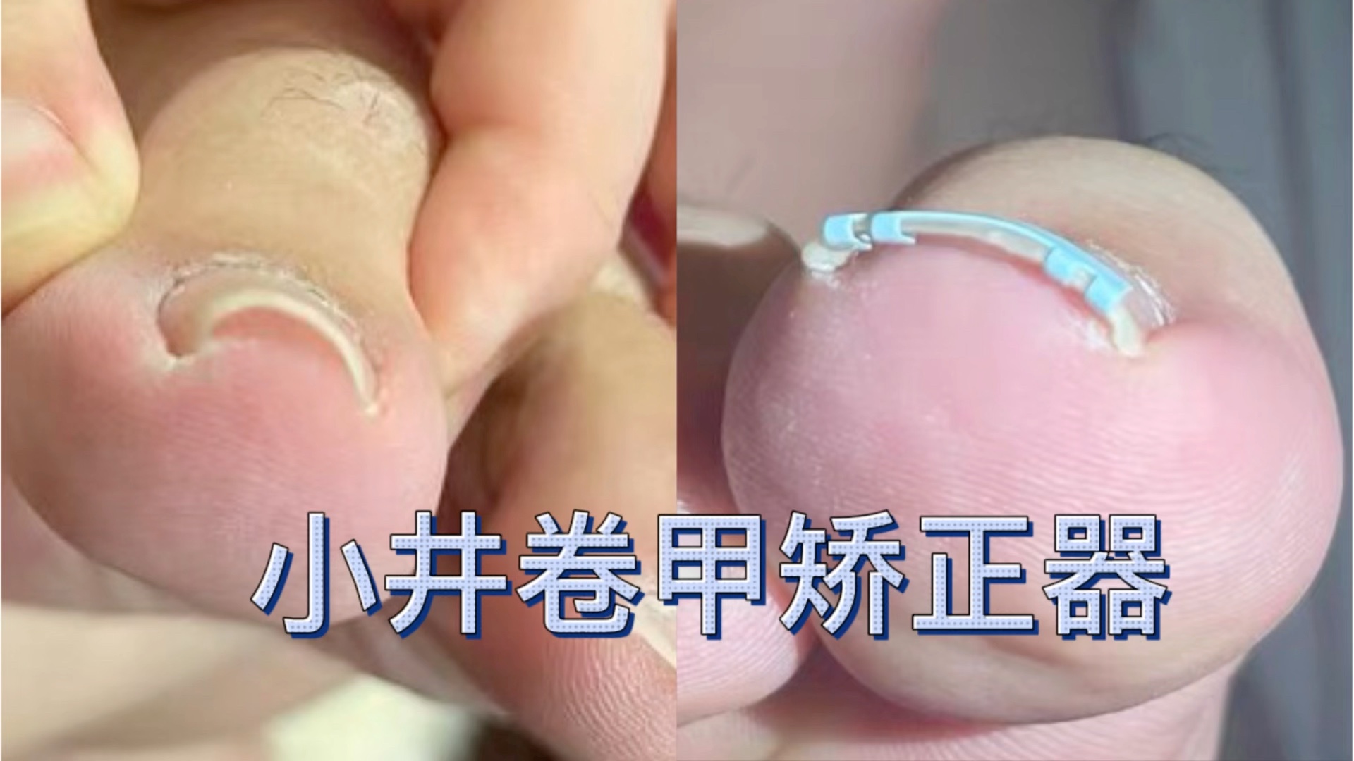 小井卷甲矫正器SUMQ#甲沟炎#嵌入甲#指甲长到肉肉里