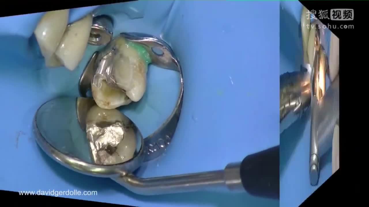 实拍嵌体补牙:嵌体的制备修复过程,牙齿健康实在太重要了!