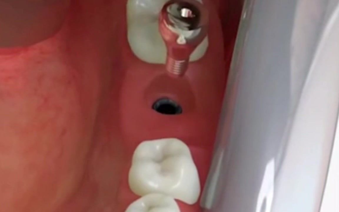 你了解种植牙全过程吗?让你看明白!