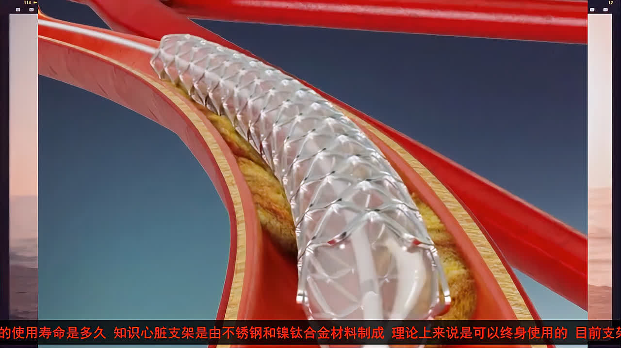 科普:心脏支架的使用寿命是多久?